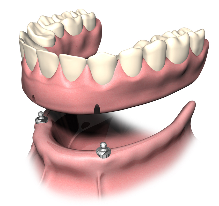 Was kosten Locator Prothesen und Kugelkopfimplantate?