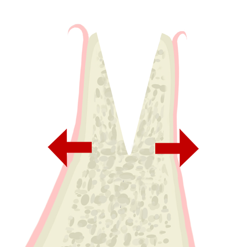 Das wird ein Knochenaufbau kosten: Preise des Kieferaufbaus