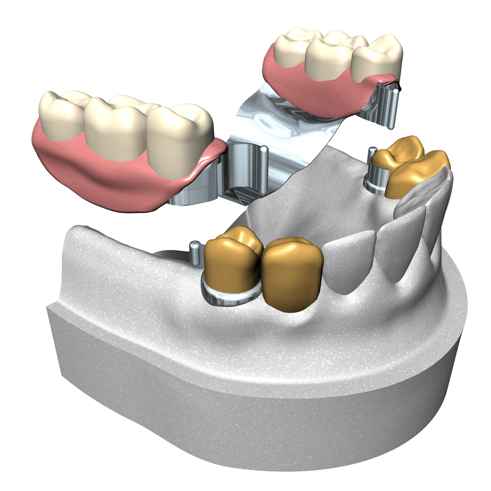 Kronen-Geschiebeprothese: Aussehen, Funktion, Kosten