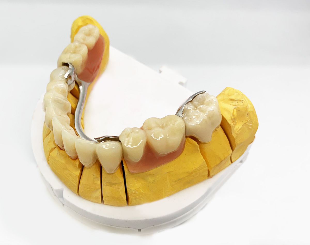 Kronen-Geschiebeprothese: Aussehen, Funktion, Kosten