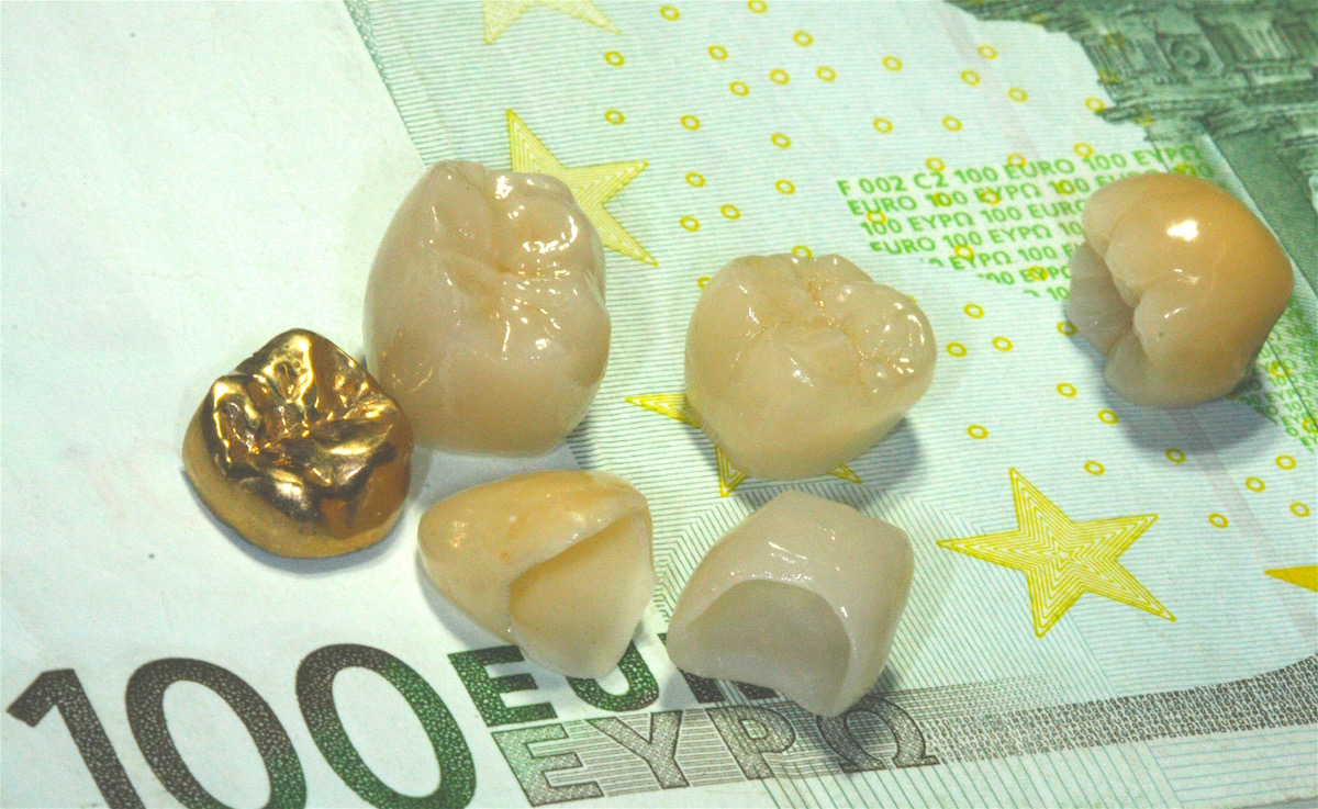 So viel darf eine Teilkrone kosten, das zahlt die Kasse