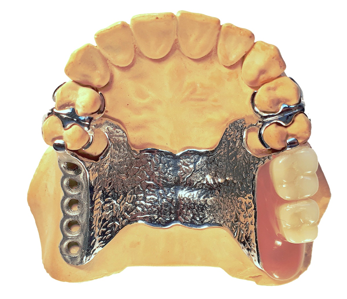 Klammerprothese (Modellgussprothese)