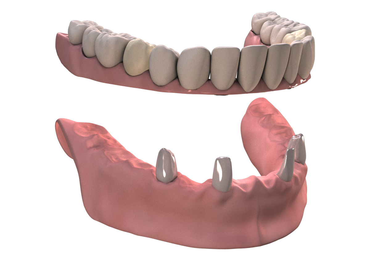 Implantat ja oder nein: so funktioniert ein Zahnimplantat