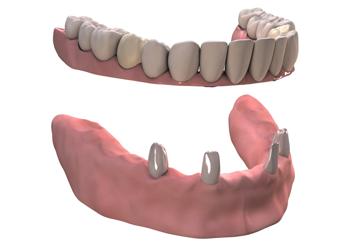 Teleskopprothese: sicherer Zahnersatz ohne Klammern