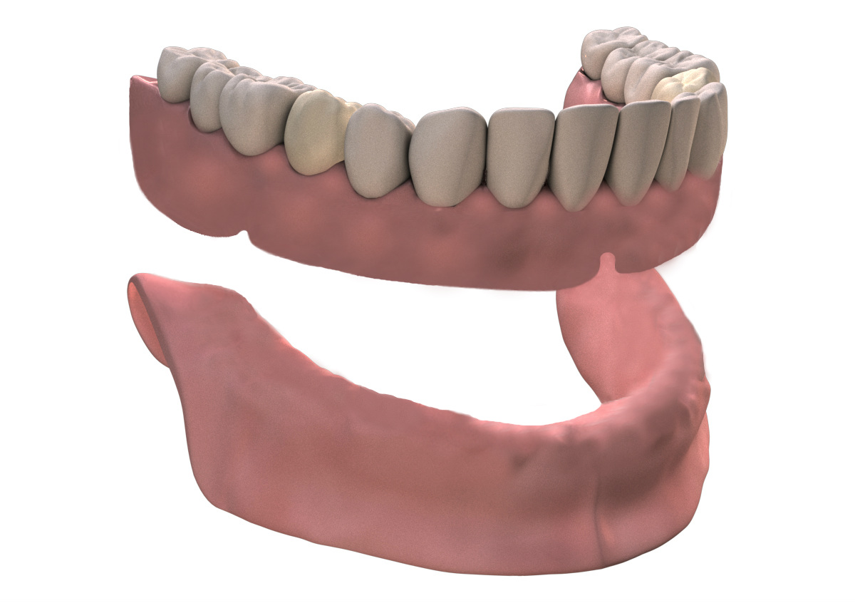 Interimsprothese - provisorischer Zahnersatz