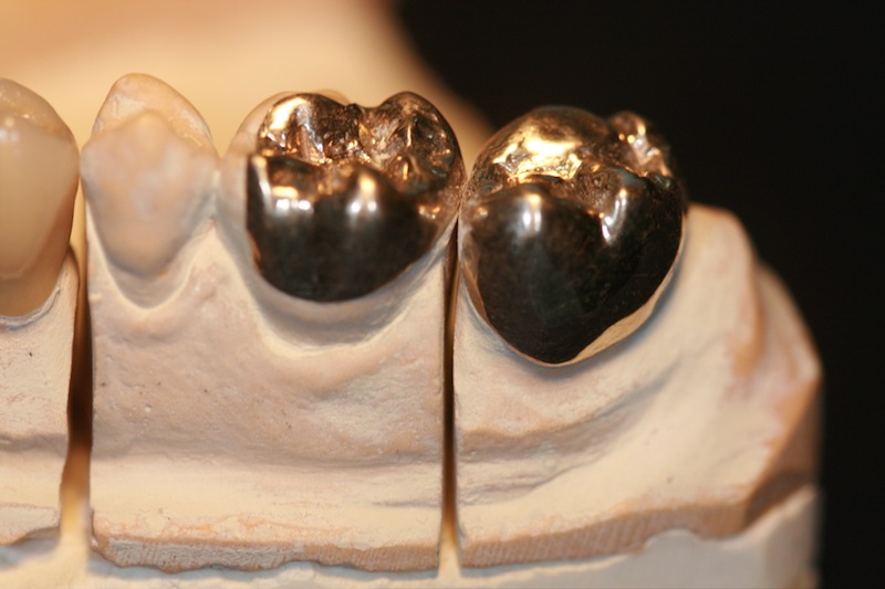 Zahnkrone aus Metall: Goldkrone, Stahlkrone, Titan