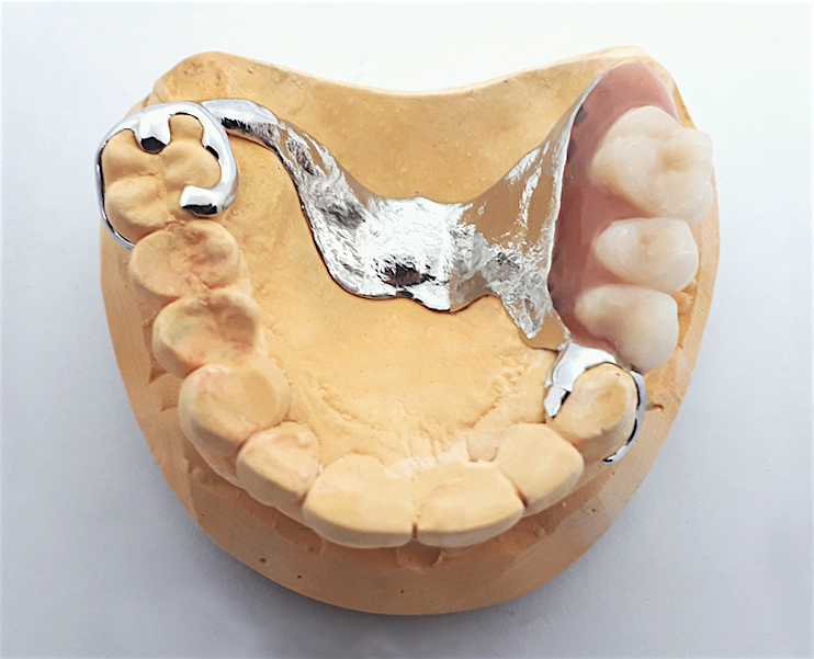 Interimsprothese - provisorischer Zahnersatz