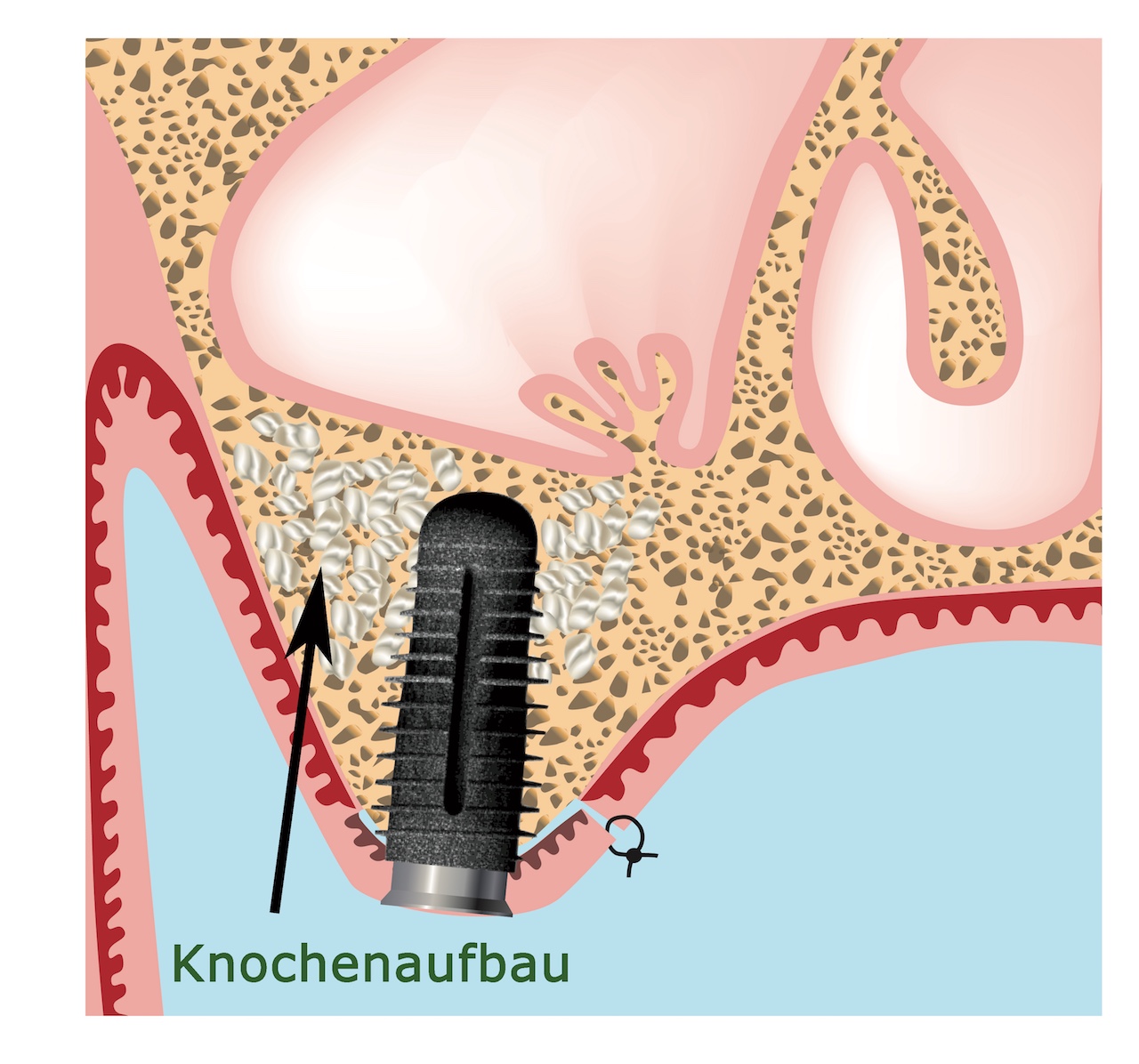 So geht ein Knochenaufbau für Zahnimplantate