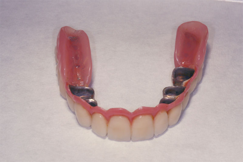 Bildgalerie Teleskopprothese auf eigenen Zähnen